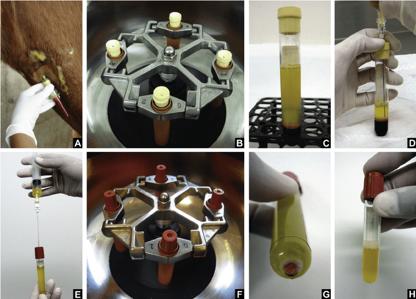PRP Preparation | Platelet Rich Plasma Therapy | PRP Injection MD